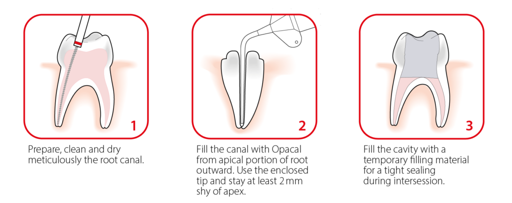 Opacal - Temporary root canal dressing | Endodontic obturation products