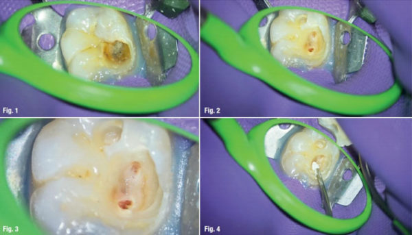 Direct pulp capping : a conservative procedure to maintain pulp vitality